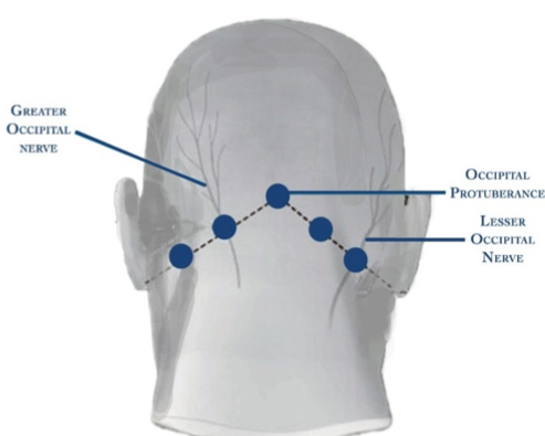 Zygomaticofacial Nerve Block