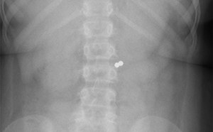 Sonoguide // Paracentesis