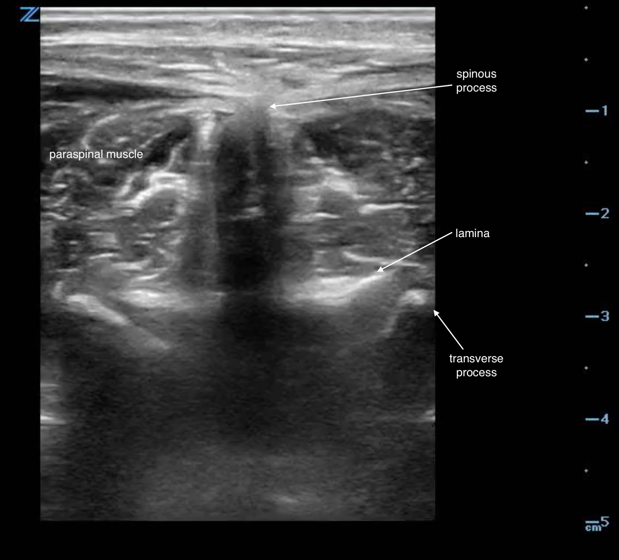 Sonoguide // Lumbar Puncture