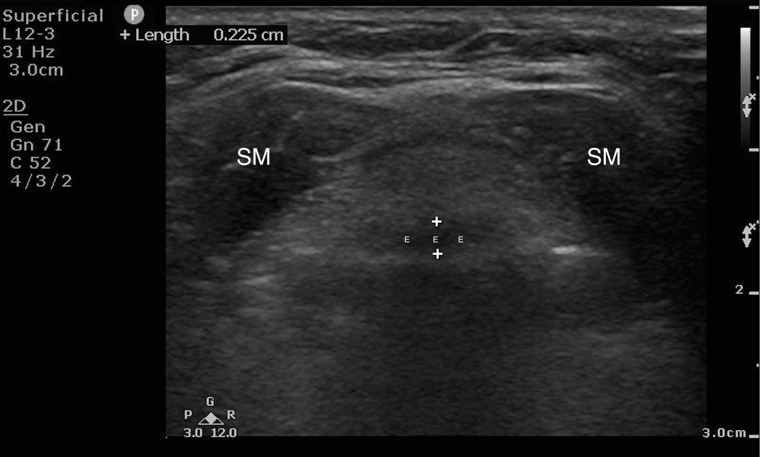 Sonoguide // Airway Emergencies