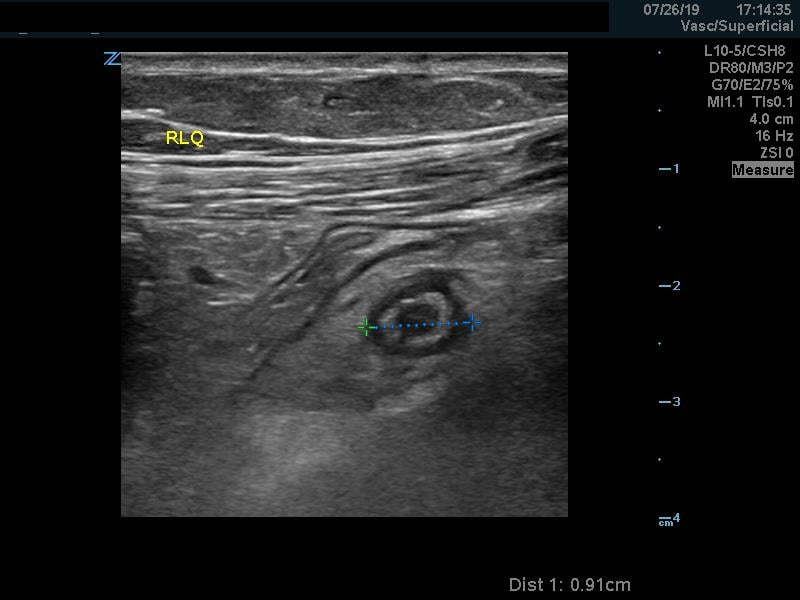 Appendicolith Ultrasound