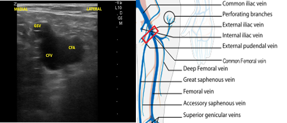 Sonoguide // Deep Vein Thrombosis (DVT)
