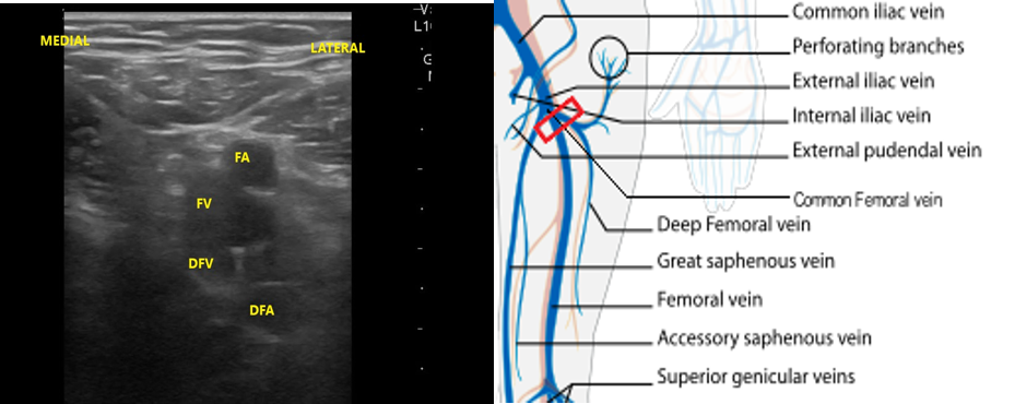 Sonoguide // Deep Vein Thrombosis (DVT)