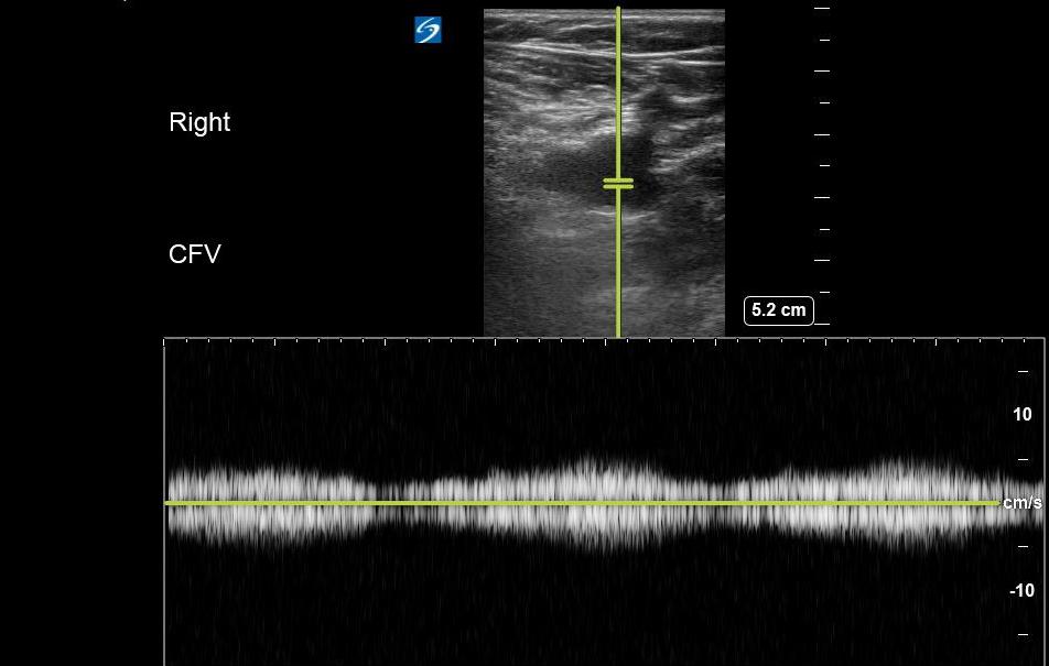 Sonoguide // Deep Vein Thrombosis (DVT)
