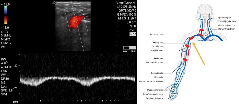 Sonoguide // Deep Vein Thrombosis (DVT)