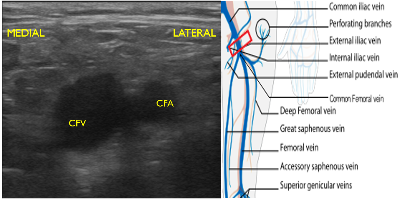 Sonoguide // Deep Vein Thrombosis (DVT)