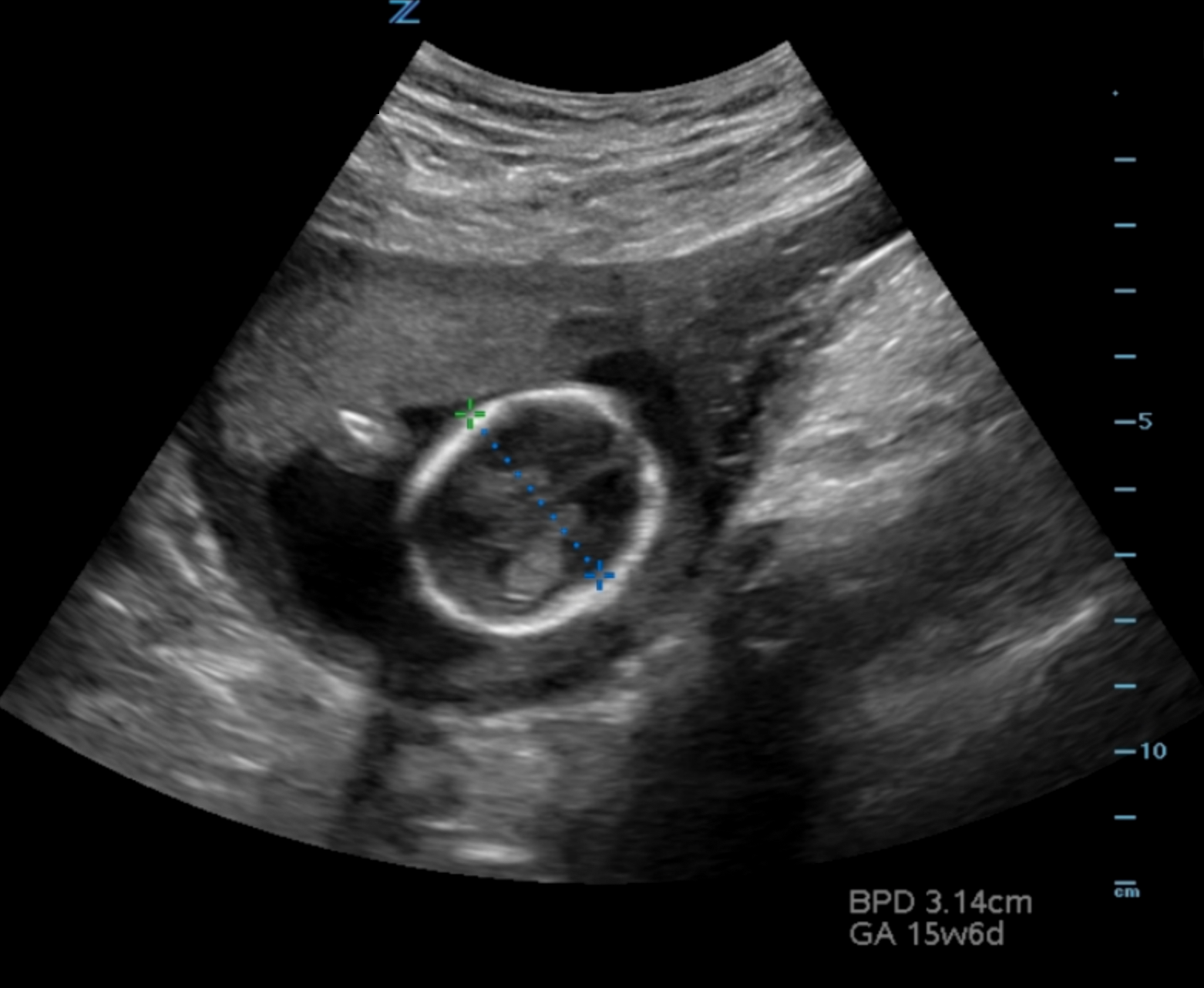 Sonoguide // Early Pregnancy