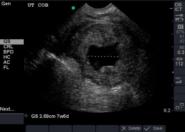 Sonoguide // Early Pregnancy