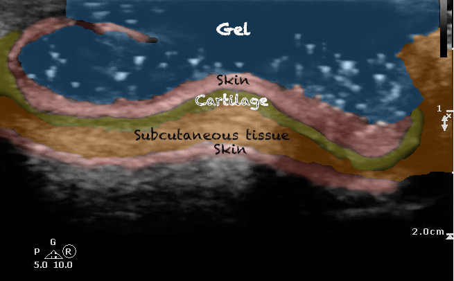 Sonoguide // ENT