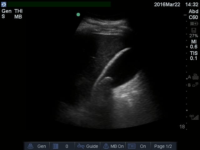 Sonoguide // Gallbladder