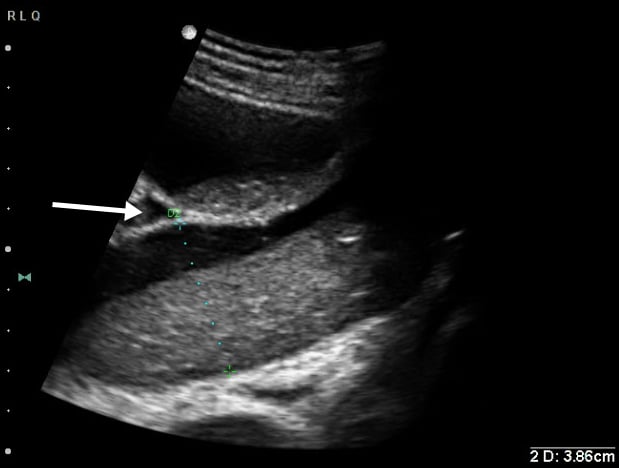 Sonoguide // GI - Bowel Obstruction
