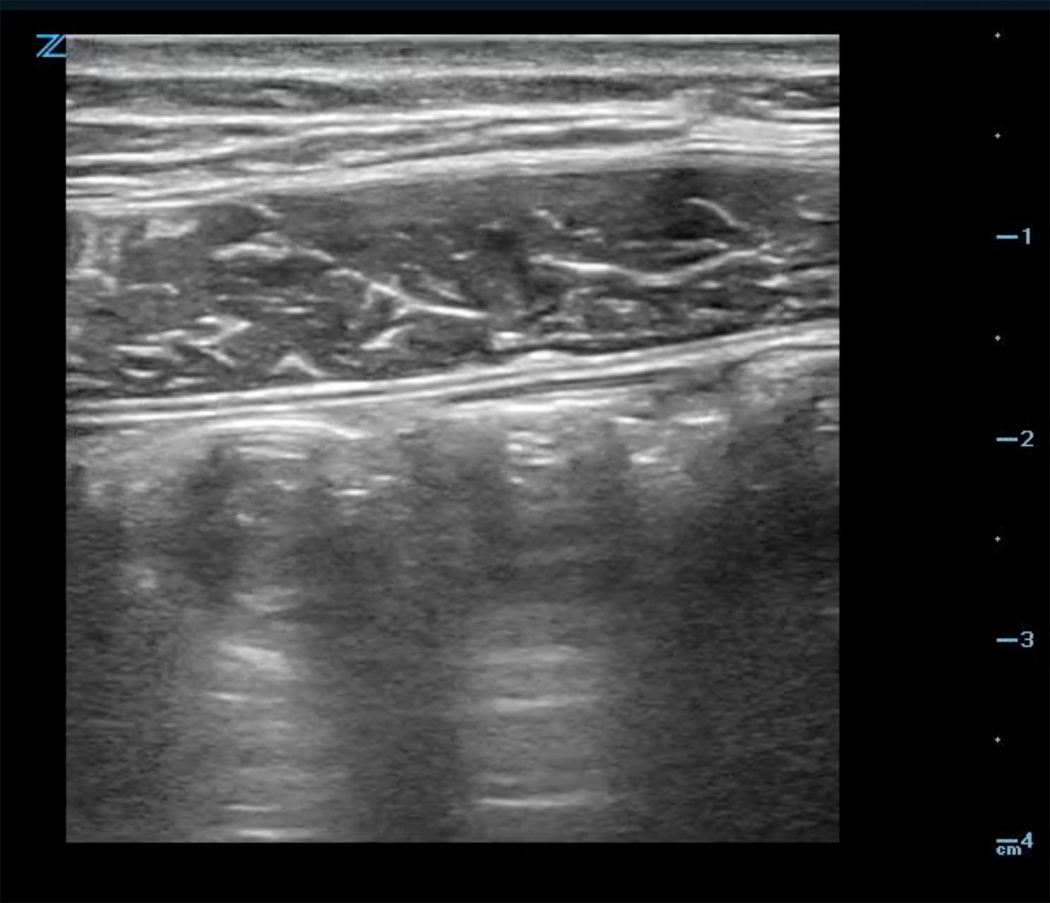 Sonoguide // Intussusception