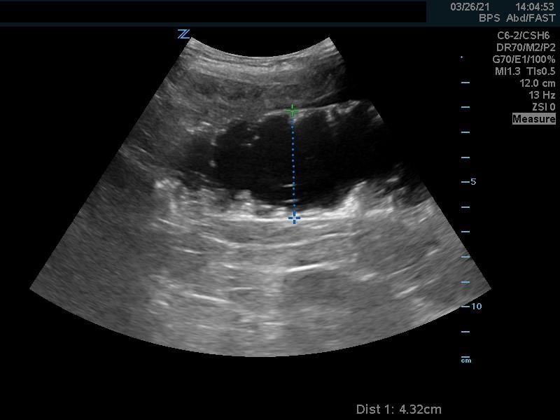 Sonoguide // Intussusception