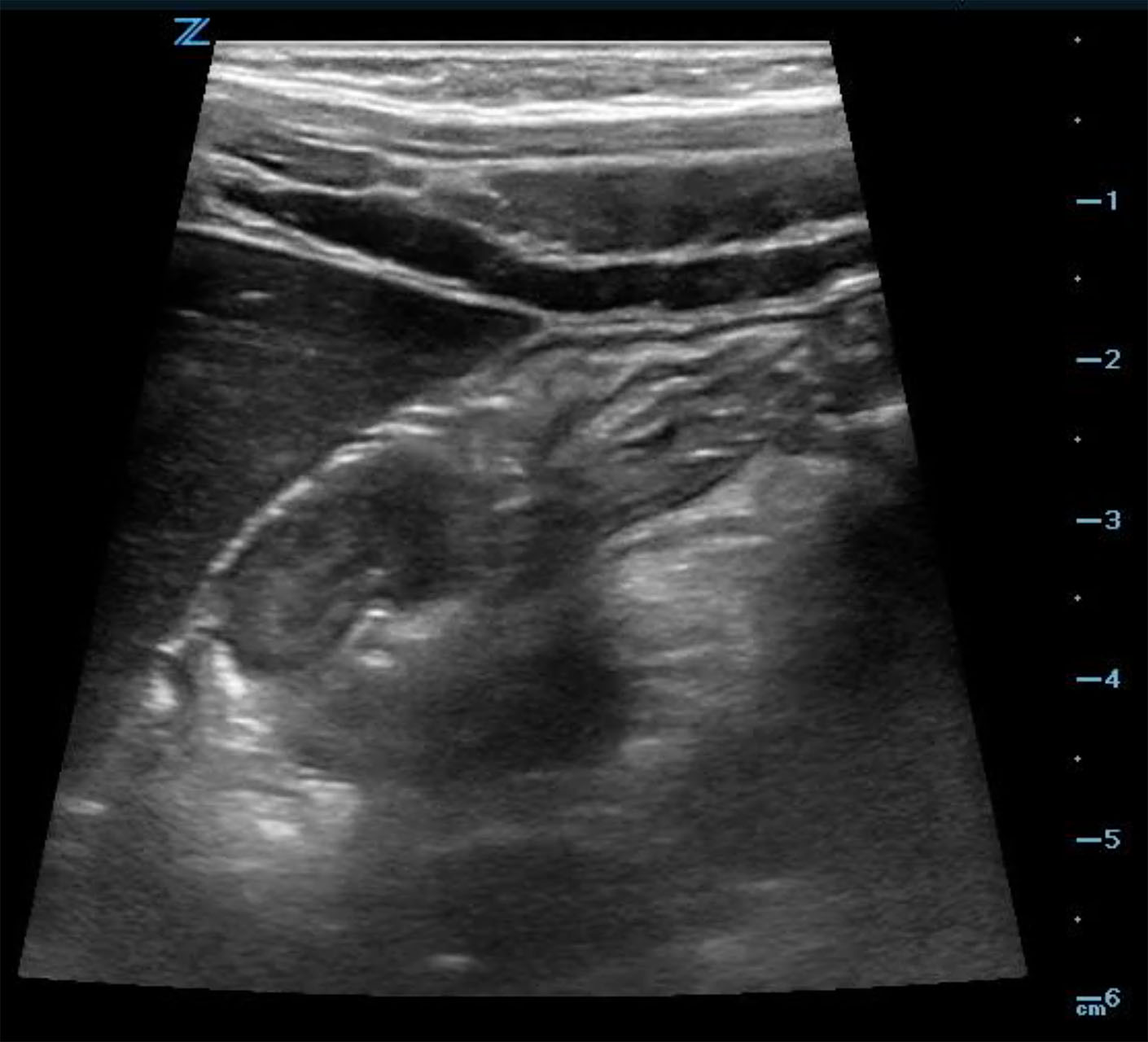 Sonoguide // Intussusception