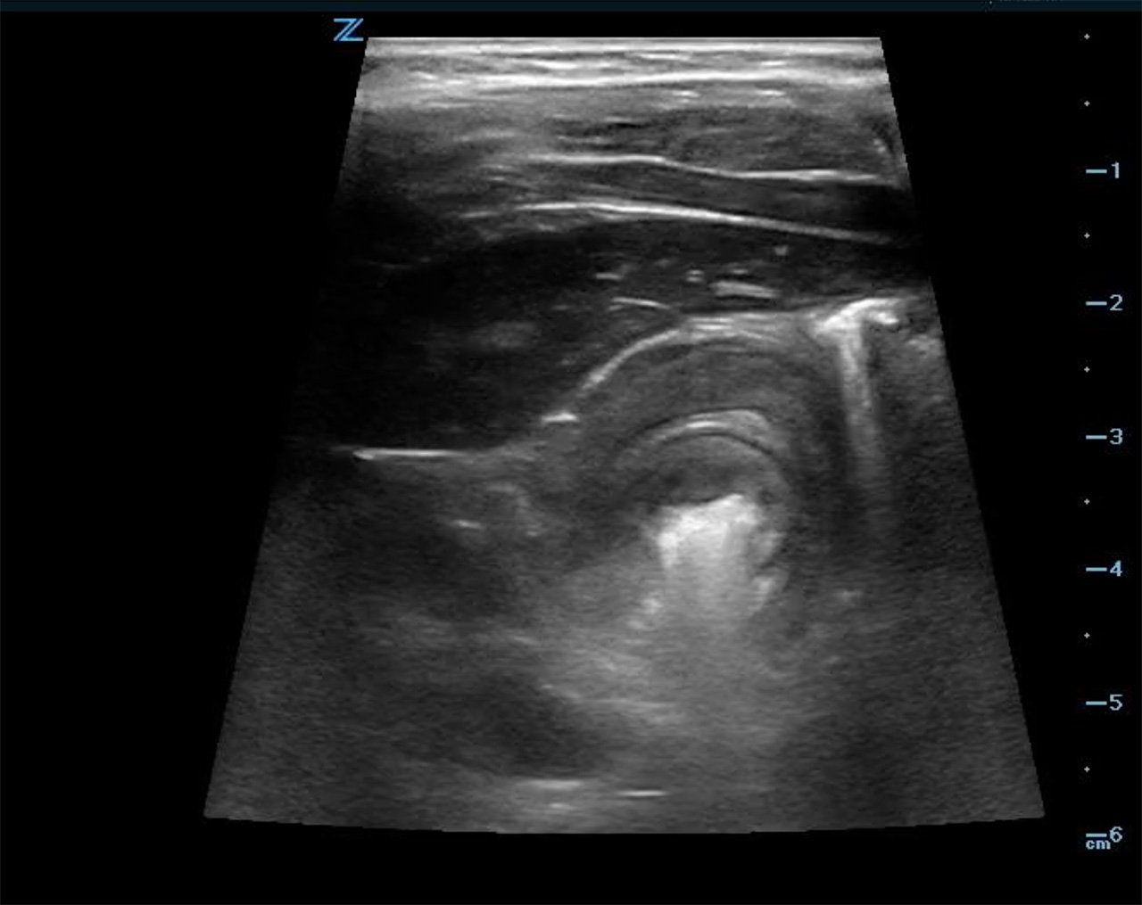 Sonoguide // Intussusception