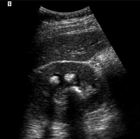 Renal Stone Ultrasound _ How To Scan A Renal Ultrasound – UPFV