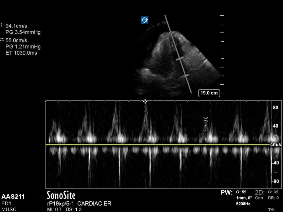 Sonoguide // Rapid Ultrasound for Shock and Hypotension (RUSH)