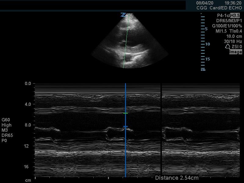 Sonoguide // Rapid Ultrasound for Shock and Hypotension (RUSH)