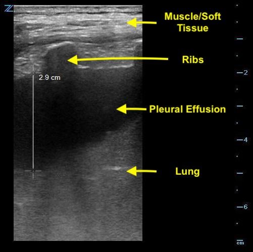 Sonoguide // Thoracentesis