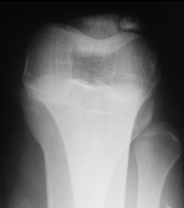 Sports Medicine Section // The Jammed Finger