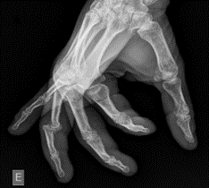 Sports Medicine Section // The Jammed Finger