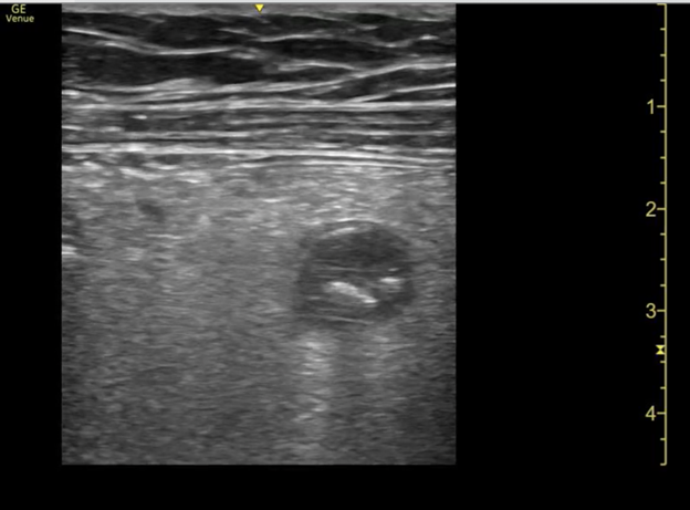 EM Ultrasound Section // How to Diagnose Appendicitis in a Child