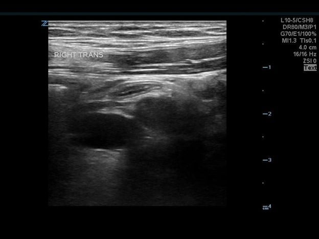 EM Ultrasound Section // How to Diagnose Appendicitis in a Child