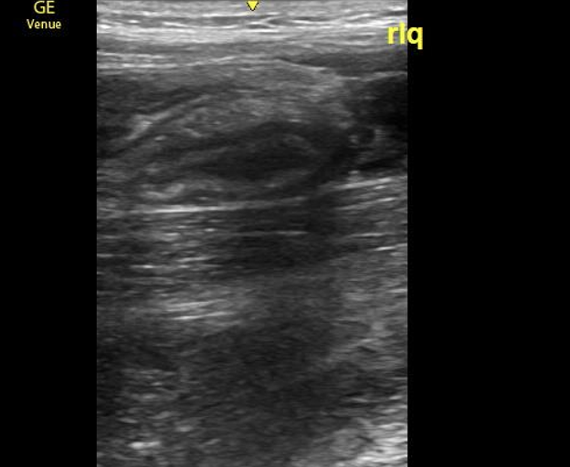 EM Ultrasound Section // How to Diagnose Appendicitis in a Child