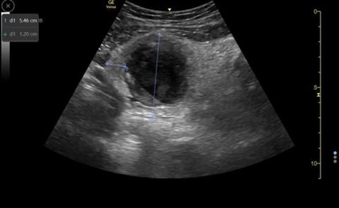 EM Ultrasound Section // How to Diagnose Appendicitis in a Child