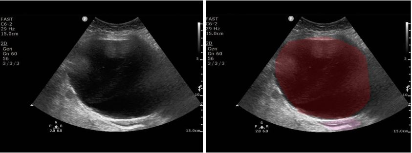 EM Ultrasound Section // Urine Trouble: Tricky Bladder Mimics