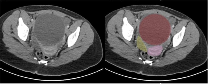 EM Ultrasound Section // Urine Trouble: Tricky Bladder Mimics