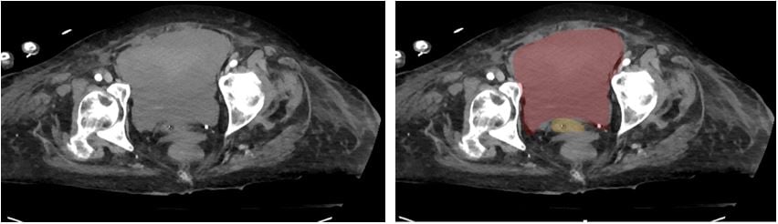 EM Ultrasound Section // Urine Trouble: Tricky Bladder Mimics