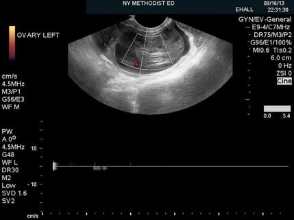 EM Ultrasound Section // Ovarian Torsion
