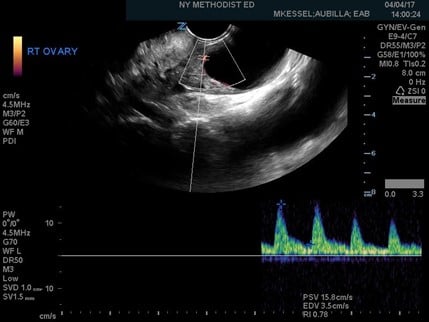 EM Ultrasound Section // Ovarian Torsion