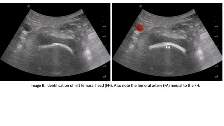 EM Ultrasound Section // Pericapsular Nerve Group (PENG) Block for ...