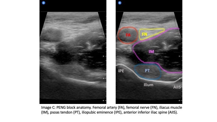 EM Ultrasound Section // Pericapsular Nerve Group (PENG) Block for ...