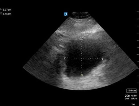 EM Ultrasound Section // POCUS for Bladder Assessment and Volume ...