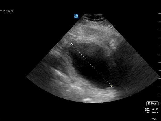 EM Ultrasound Section // POCUS for Bladder Assessment and Volume ...
