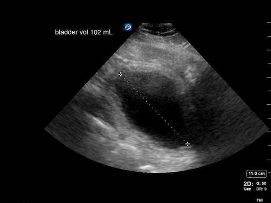 EM Ultrasound Section // POCUS for Bladder Assessment and Volume ...