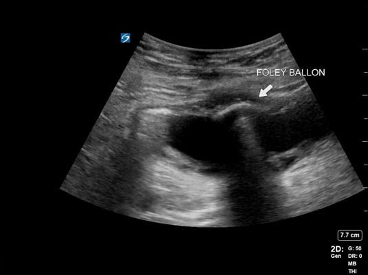 EM Ultrasound Section // POCUS for Bladder Assessment and Volume ...