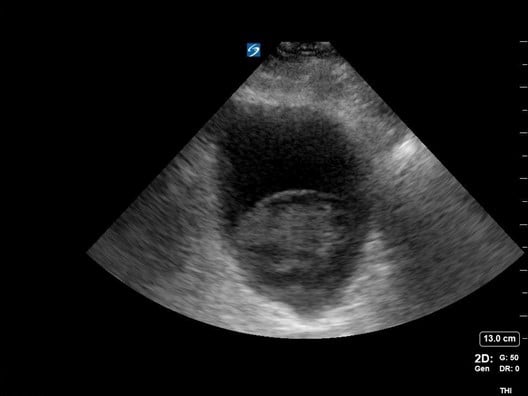 EM Ultrasound Section // POCUS for Bladder Assessment and Volume ...