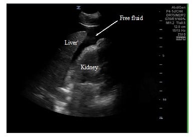 EM Ultrasound Section // Cases that Count: Serial FAST examinations in ...