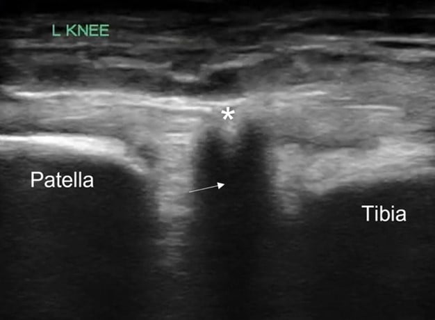 EM Ultrasound Section // Cardiac Tamponade and Ultrasound-Guided ...