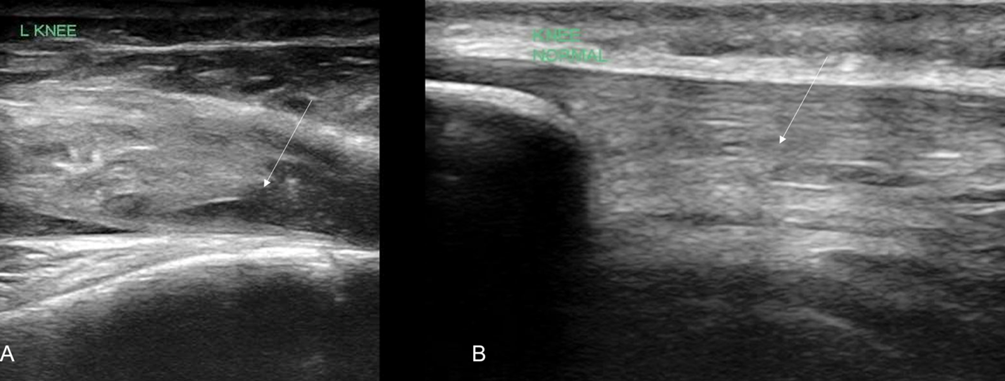 EM Ultrasound Section // Cardiac Tamponade and Ultrasound-Guided ...