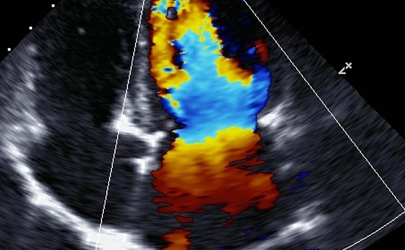 EM Ultrasound // Venous Doppler and IV Fluid Administration