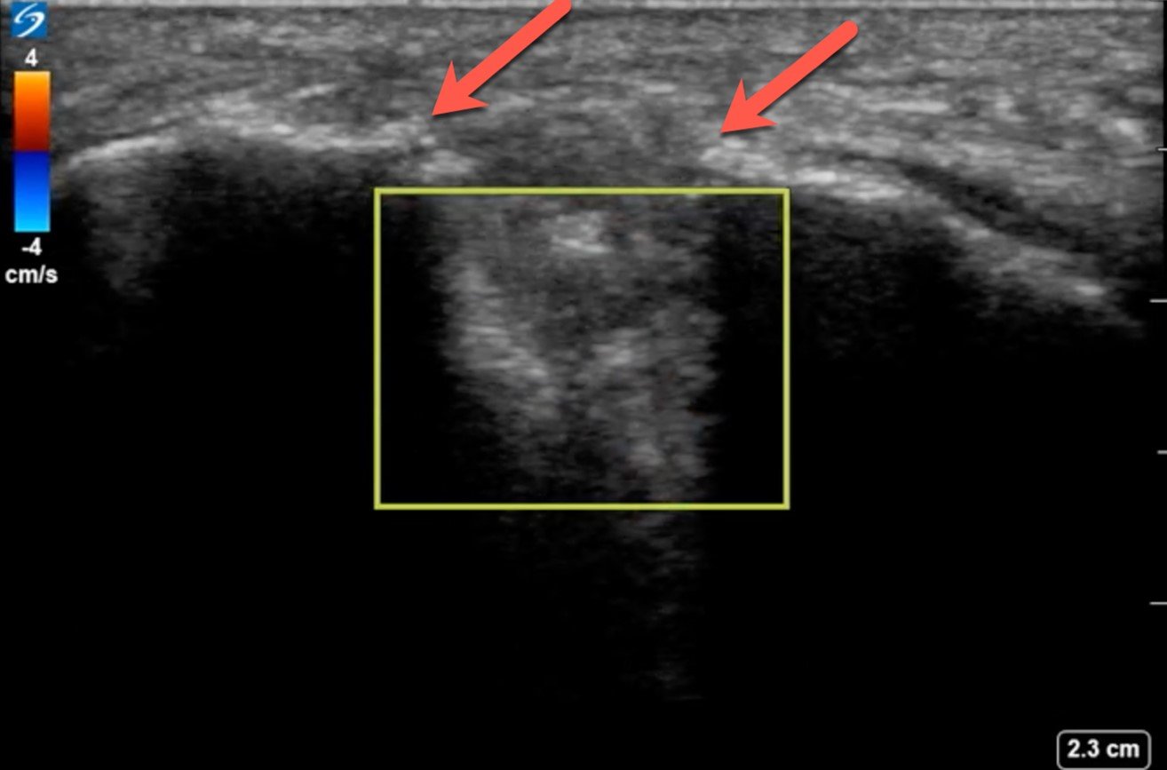 EM Ultrasound Section // When the X-ray is Negative: Using POCUS to ...