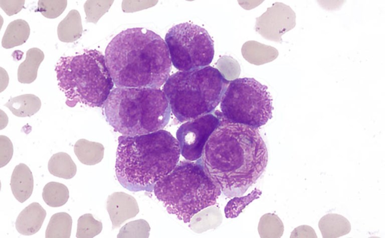 Acute Promyelocytic Leukemia | Critical Care Medicine Section