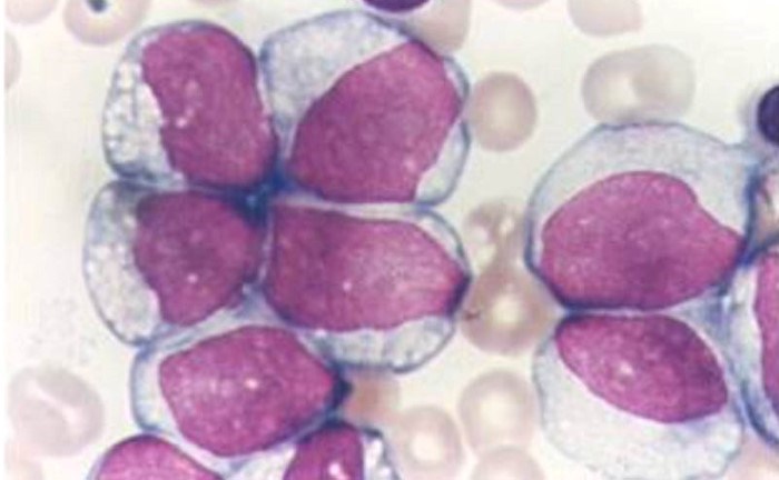 Hyperleukocytosis and Leukostasis | Critical Care Medicine Section