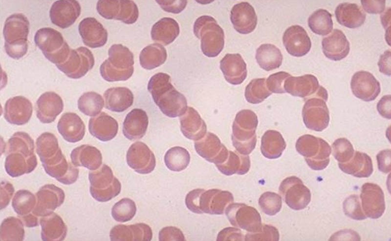 Hyperviscosity Syndrome | Critical Care Medicine Section