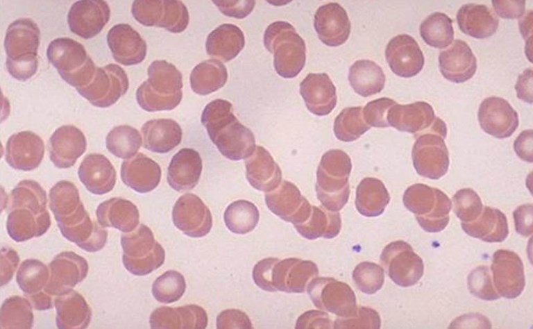 Hyperviscosity Syndrome | Critical Care Medicine Section